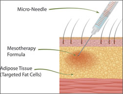 mesotherapy treatment at our dermatologists office in Rochester ...