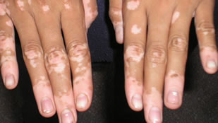 dermatologist in Rochester treating Vitiligo treatment in Rochester